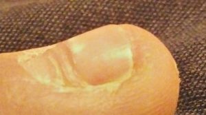 Do You Have These Horizontal Ridges(Lines) On Your Nails?-Palmistry